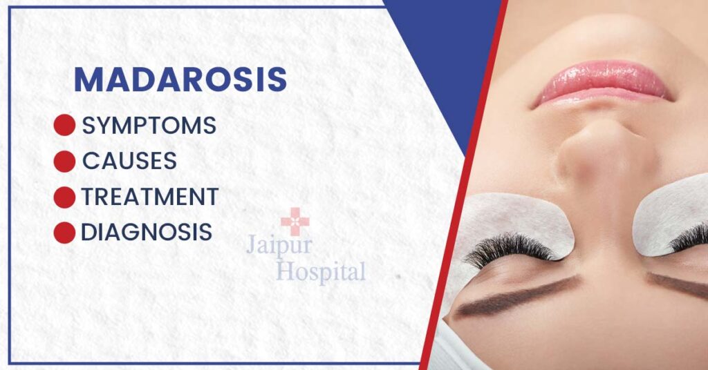 Madarosis: Symptoms, Causes, Diagnosis, and Treatment - Jaipur Hospital