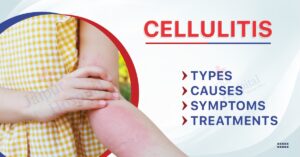 Cellulitis: Types, Causes, Symptoms, and Treatments