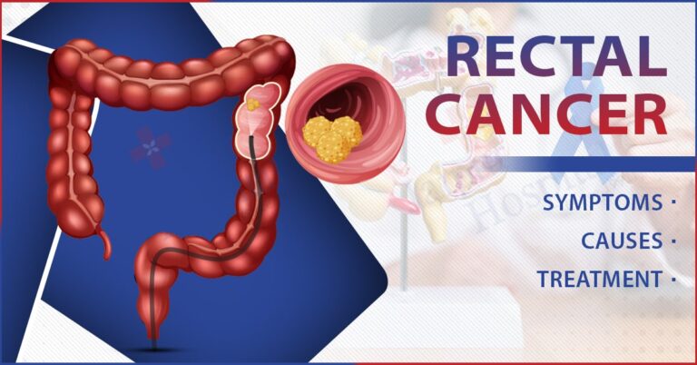 Rectal Cancer Causes, Symptoms and Treatment
