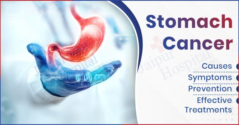 Stomach Cancer : Causes, Symptoms, Prevention & Effective Treatments